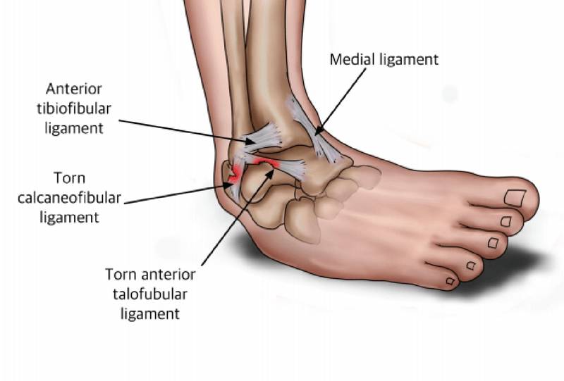 Ankle Sprains Fractures Premier Foot Ankle Center 5 Stars 