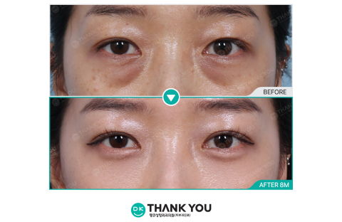 Best Eye Bag Treatments: Type-Based Solutions for Dark Circles and ...