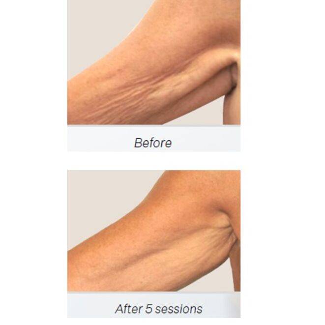 Cryo Beauty Results – Cryo Nation