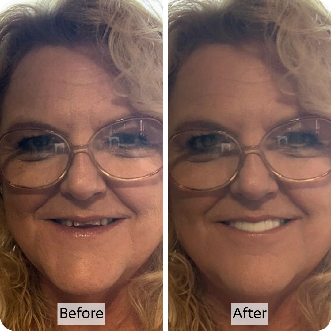 Chipped Teeth | What Instasmile Can Help With