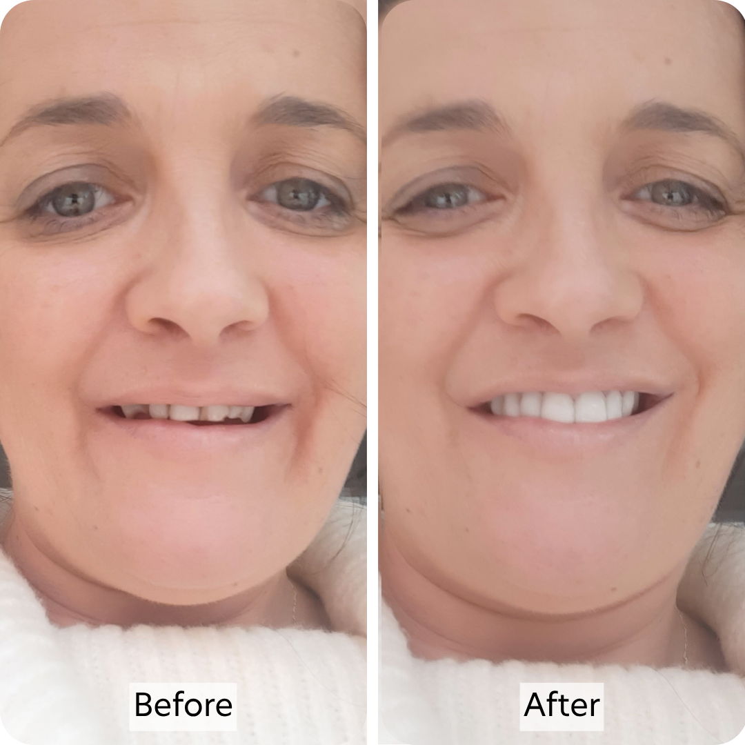Chipped Teeth | What Instasmile Can Help With