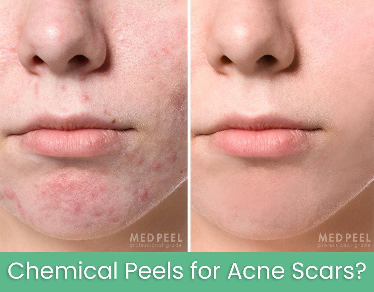 Best chemical peels for acne scars– Medpeel Best chemical peels for acne scars– Medpeel