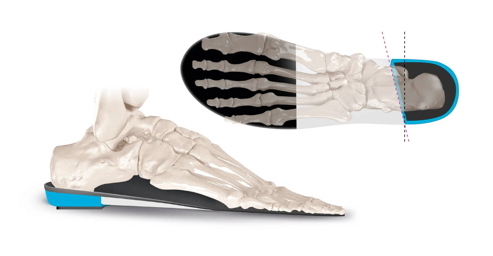 Medial Oblique Extrinsic Rearfoot Post – KevinRoot Medical